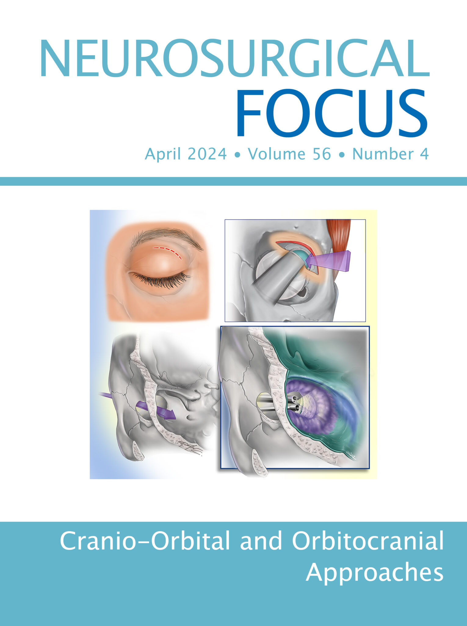 Journal of Neurosurgery Publishing Group - AANS