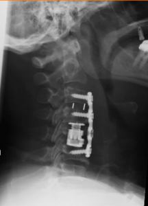 Cervical Spine - AANS