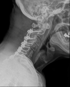 Cervical Spine - AANS