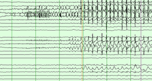 Epilepsy - AANS